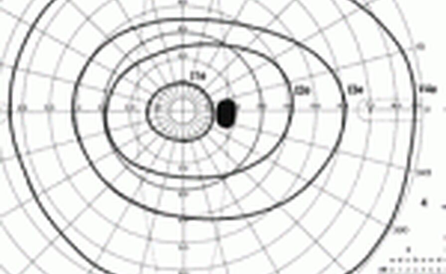 Interpreting Bjerrum and Goldmann Visual Fields • NextSense