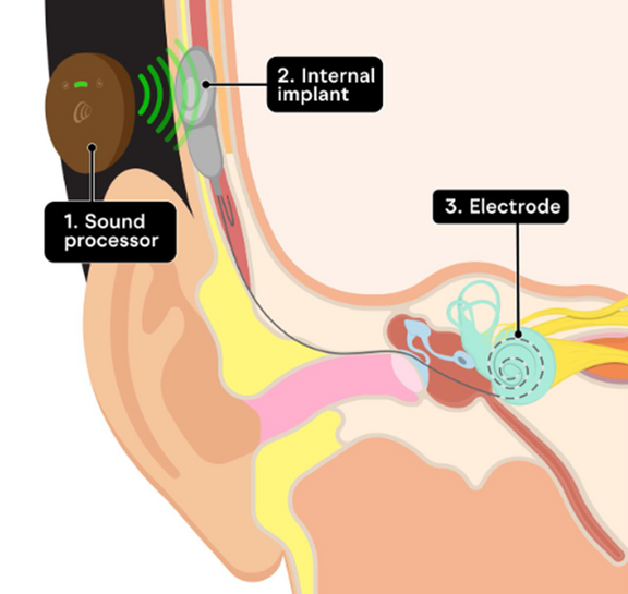 About cochlear implants • NextSense